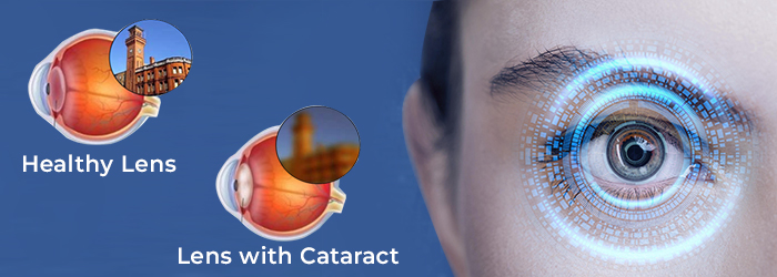 Cataracts - The leading cause of preventable blindness