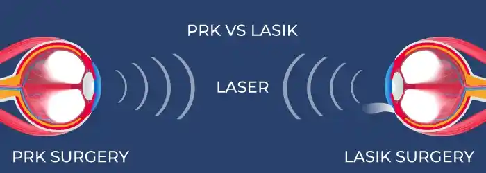 7 Key Differences Between PRK And LASIK